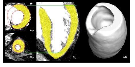 Figure 1 From Patient‐specific 17‐segment Myocardial Modeling On A Bulls‐eye Map Semantic Scholar