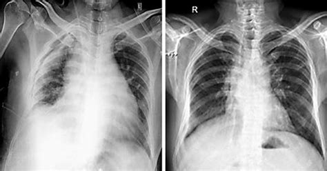 Left Chest Radiograph At Diagnosis Showing A Right Pyopneumothorax Download Scientific Diagram