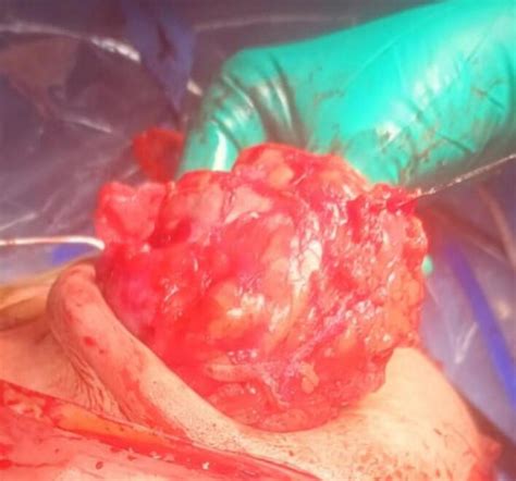 Giant Juvenile Fibroadenoma A Case Report Pmc