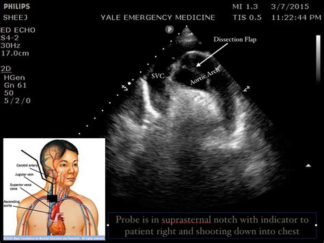 Jeffrey Shih Md On Twitter Aortic Dissection Flap On Suprasternal