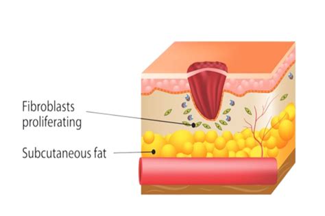 Medifelz Ostomy Care