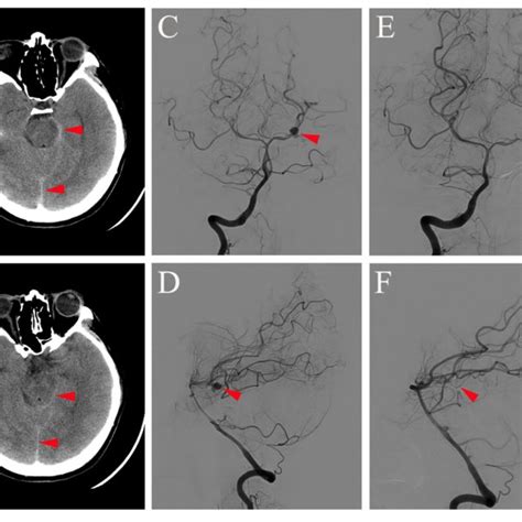 Eeg A Showed Spike And Slow Wave Complexes In The Left Occipital