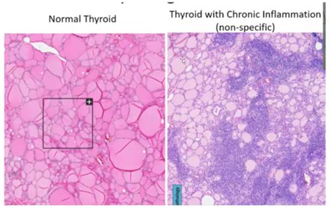 Morphological Patterns Of Chronic Inflammation Flashcards Quizlet