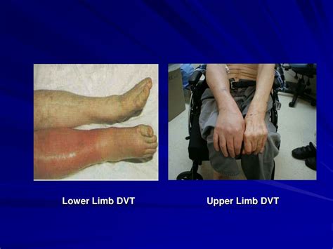 Ppt Incidence Powerpoint Presentation Free Download Id157921