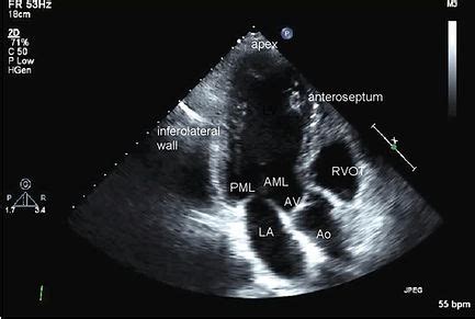 Apical Long Axis Echocardiographer Or