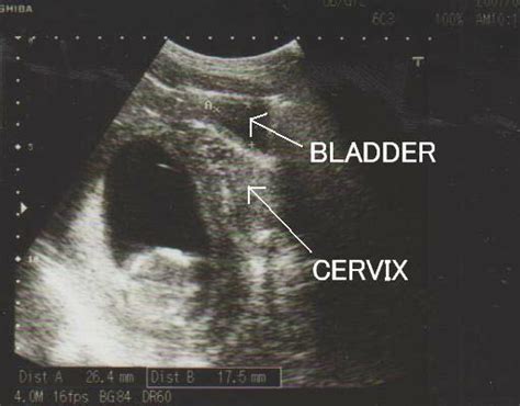 Transabdominal Ultrasonography Showing The Retroverted Gravid Uterus At