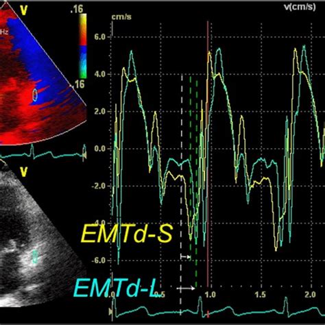 Left Atrial Longitudinal Strain Parameters Pals Peak Atrial