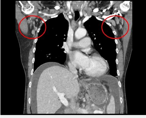 Ct Chest With Contrast 29 Showing Bilateral Axillary Adenopathy Red