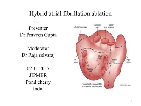 Hybrid Atrial Fibrillation Ablation Pptx Heart And Cardiovascular Diseases Diseases And
