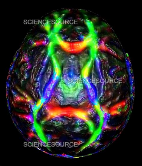 Normal Brain Dti Scan Stock Image Science Source Images