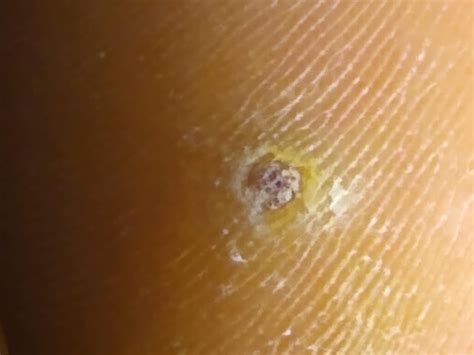 Hole In Foot Rdiagnoseme