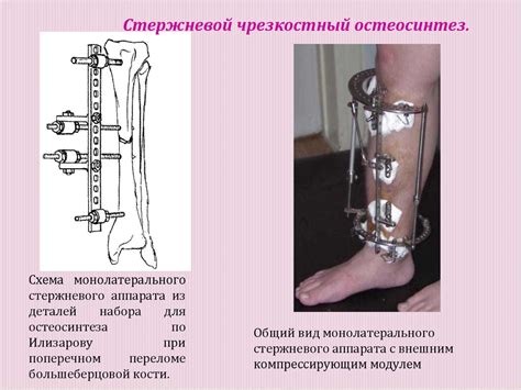 Основные принципы лечения переломов презентация онлайн