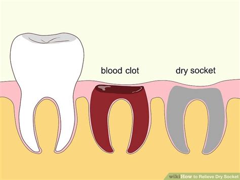 Ways To Relieve Dry Socket WikiHow