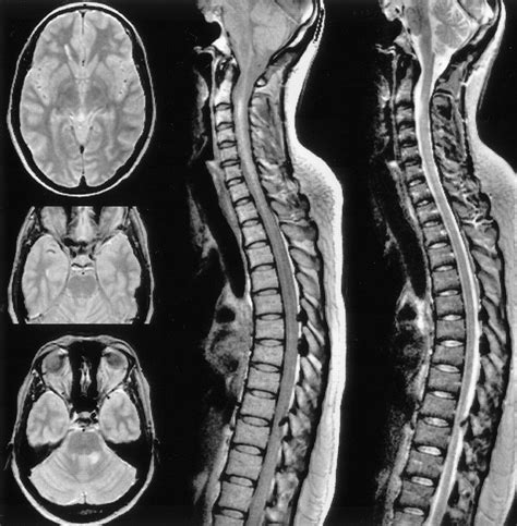 16 Early Signs You Might Have Multiple Sclerosis Artofit