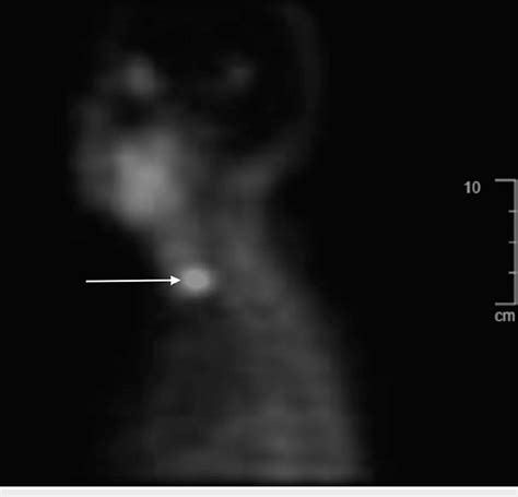 Sagittal Plane Of Sestamibi Scan Indicating Single Parathyroid Adenoma