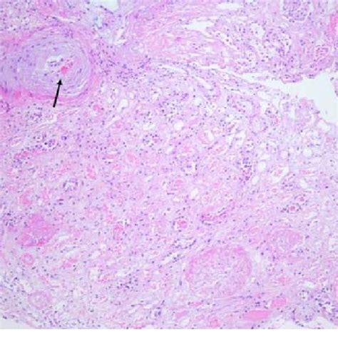 The Mucoid Intimal Hyperplasia Of The Large Sized Artery With Prominent Download Scientific