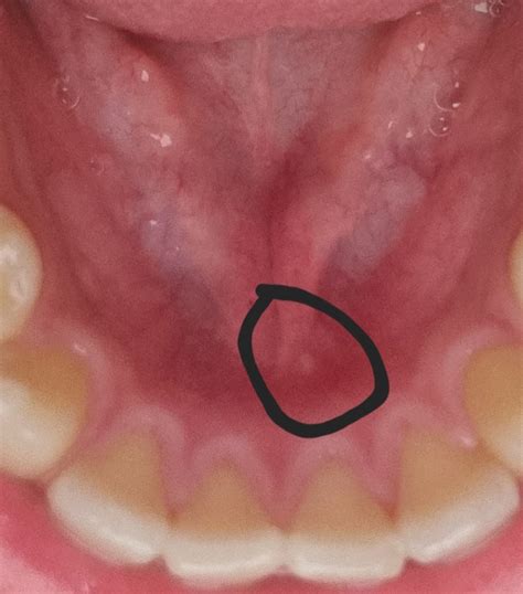 혀 밑에 뭐가 났어요 지식in