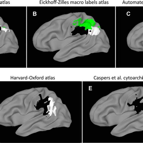 Left Inferior Parietal Lobule As Defined In Four Electronic Atlases A Download Scientific