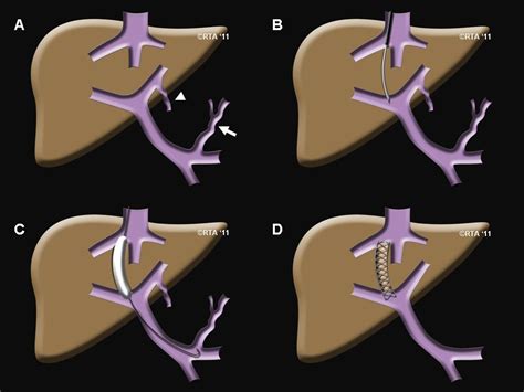 Portasystemic Shunt Surgical Portosystemic Shunt Surgical