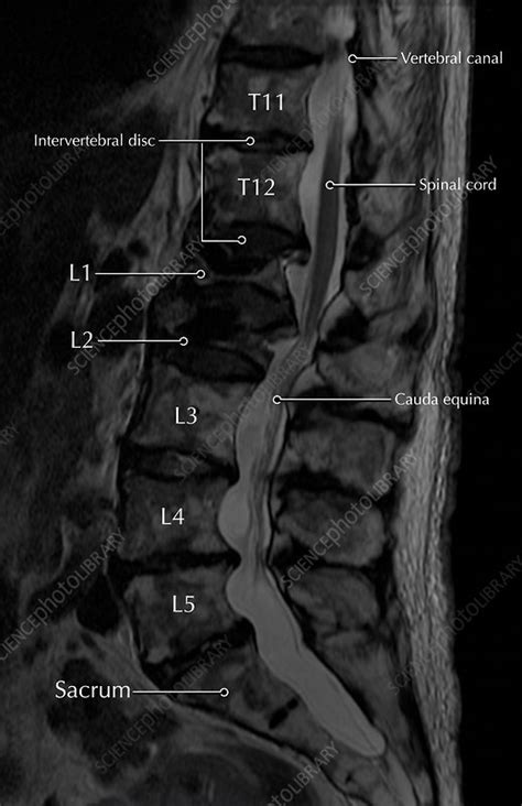 Lumbar Compression Fracture Stock Image C0271210 Science Photo Library