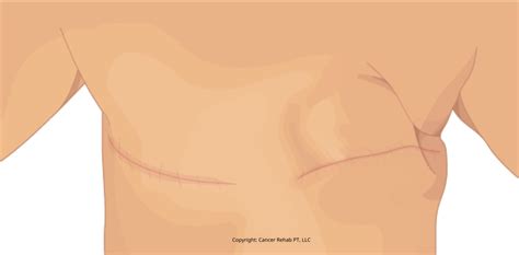Mastectomy Scars What They Look Like And Management Tips Cancer Rehab Pt