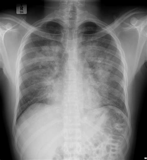 Pulmonary Edema Xray Re Expansion Pulmonary Edema Radiology Case