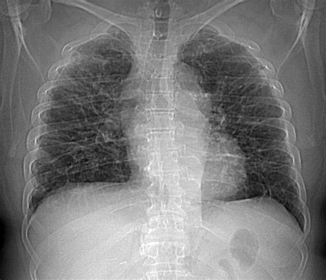151lu End Stage Iv Sarcoidosis The Common Vein
