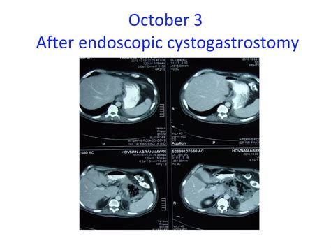 Retroperitoneal Endoscopic Necrosectomy Ppt Digestive Disorders Diseases And Conditions