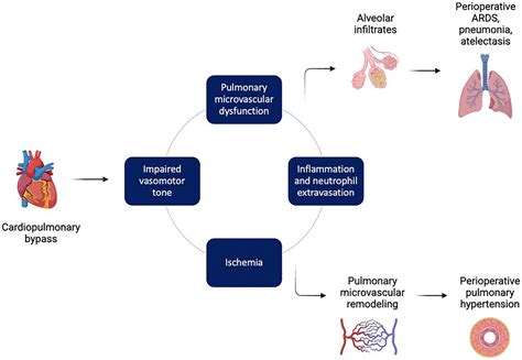 Cardiopulmonary Bypass Causes Symptoms Treatment Cerebral Air Embolism