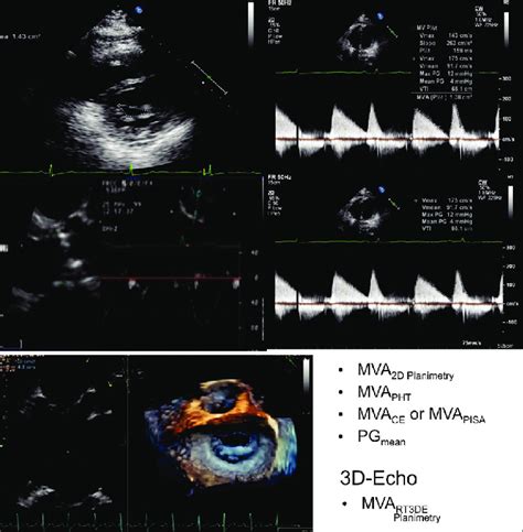 Quantification Of Mitral Valve Stenosis Two Dimensional Doppler Mitral Download Scientific