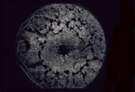 Pattern Dystrophy Retina Image Bank