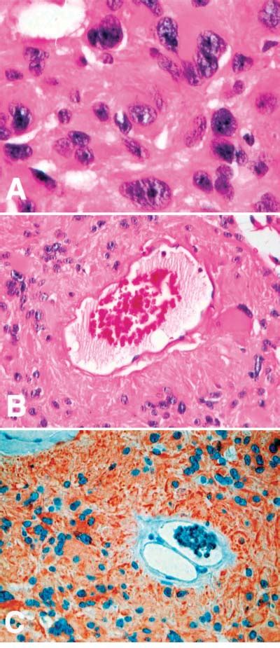 Photomicrographs Of The Cervical Giant Cell Ependymoma A Pleomorphic