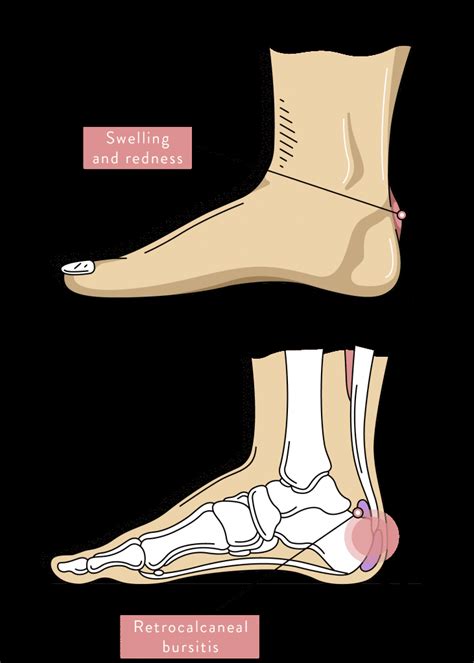 Back Of Heel Pain Causes