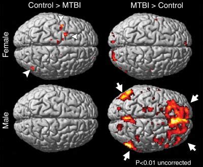 Sex Differences Initial Study IMAGE EurekAlert Science News Releases