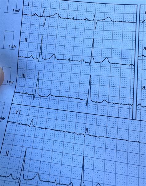 Right Bundle Branch Block Or Normal U Can See It Towards The End R Readmyecg