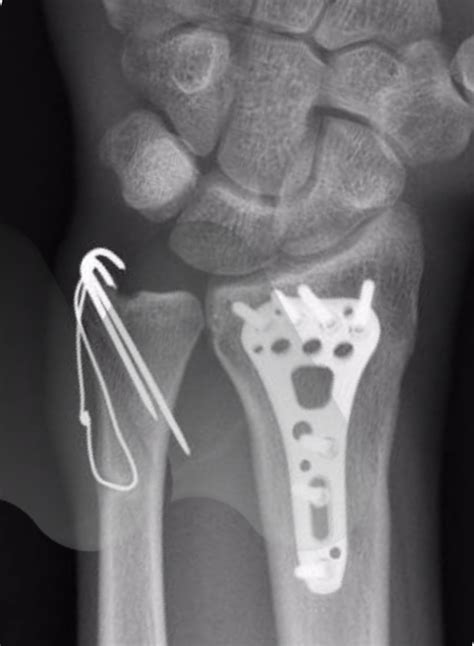 Colles Fracture Backslab