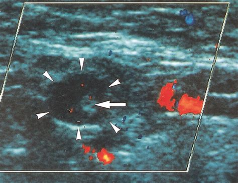 Contrast Enhanced Color Doppler Sonography For Evaluation Of Enlarged