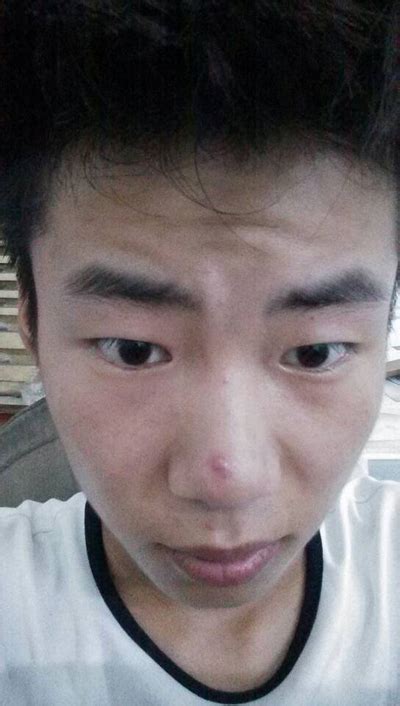 鼻子上长脓包 18有来医生