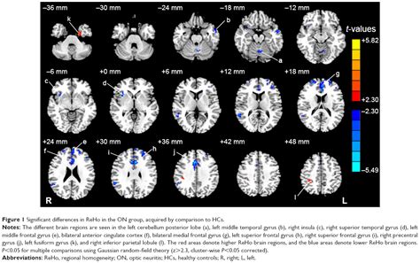 Altered Intrinsic Regional Spontaneous Brain Activity In Patients With Ndt