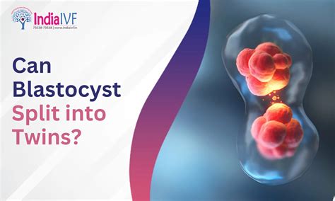 Expert Insights On Whether A Blastocyst Can Split Into Twins In Ivf