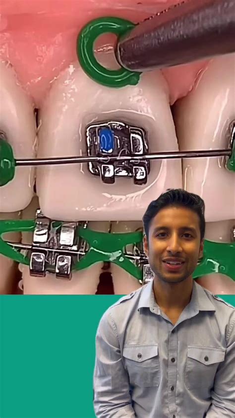 Did You Know Your Ties Are More Than Just A Fashion Statement Video Orthodontics Braces