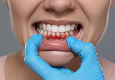 Periodontal Scaling And Root Planing Ar Smiles