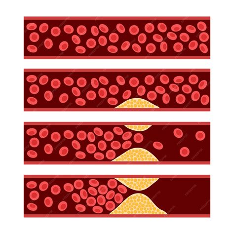 콜레스테롤과 죽상동맥경화증 프리미엄 벡터