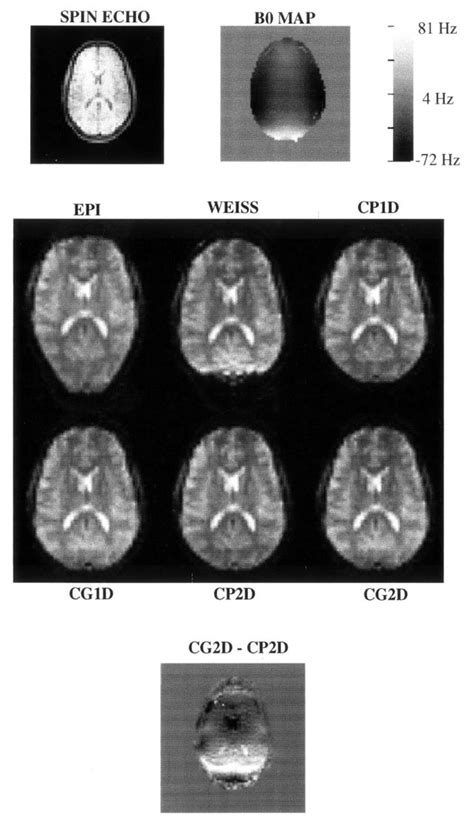 Distortion Correction On A Volunteers Head Epi Image Download Scientific Diagram