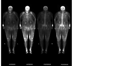 Bone Scan Showing Moderate Tracer Uptake In The Adipose Tissue Of Both Download Scientific