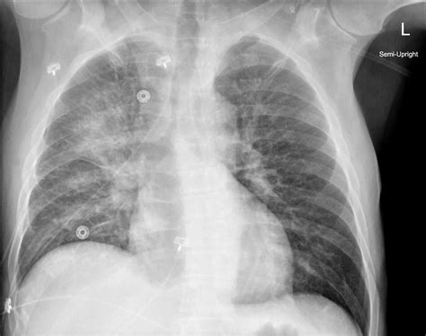 Pulmonary Edema Causes Symptoms Diagnosis Treatment And Prognosis