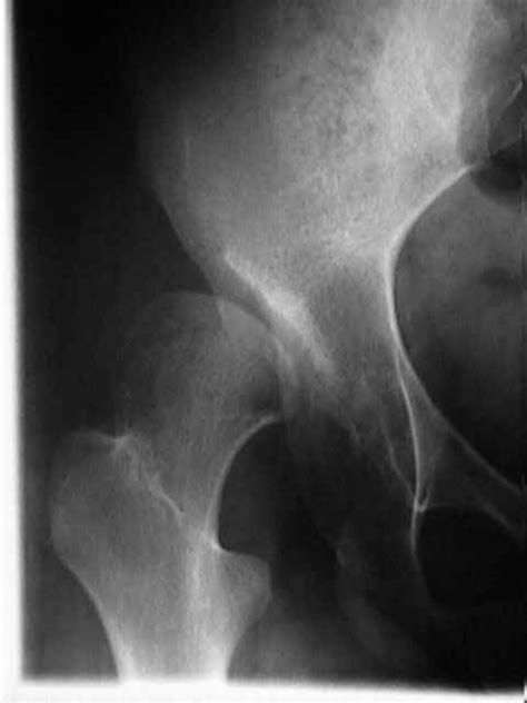 Ce Angle Of Wiberg Wheeless Textbook Of Orthopaedics