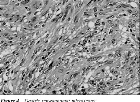 Figure 4 From Mesenchymal Non Epithelial Non Gist Tumors Of The