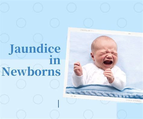 Jaundice In Newborns Causes And Treatment Noodle Soup