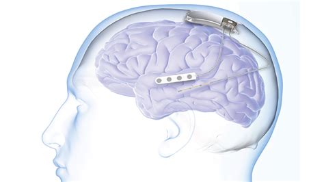 Responsive Neurostimulation The Defeating Epilepsy Foundation